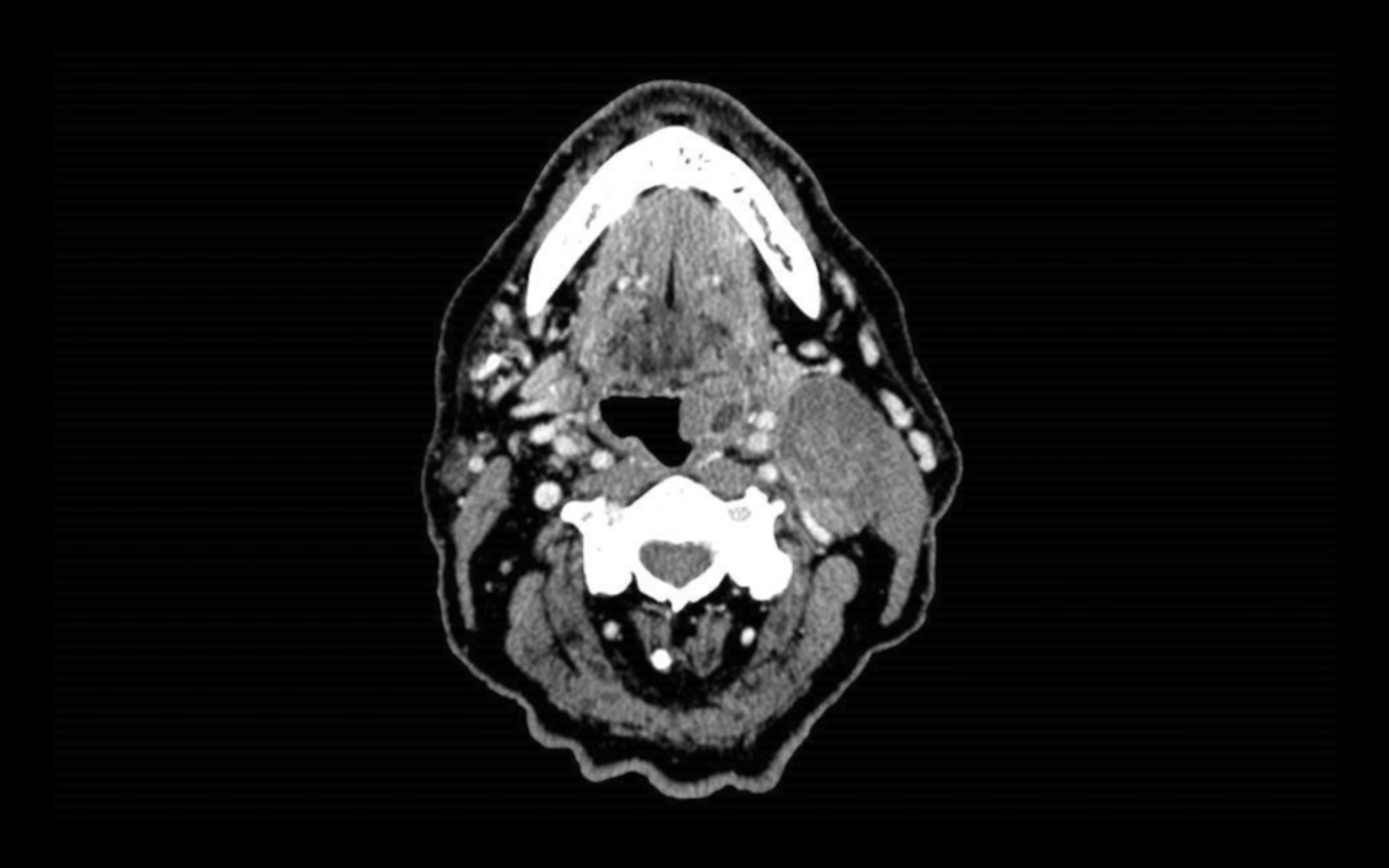Radical Tonsillectomy for HPV+ Oropharyngeal Cancer – Head and Neck ...