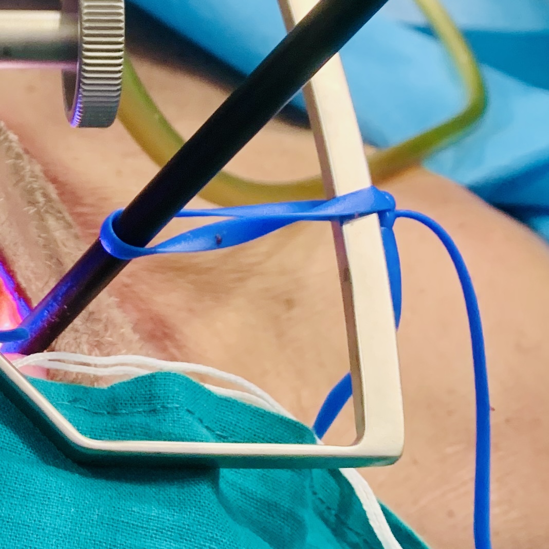 Stabilizing Versius Instruments in TORS – Head and Neck Robotic Surgery